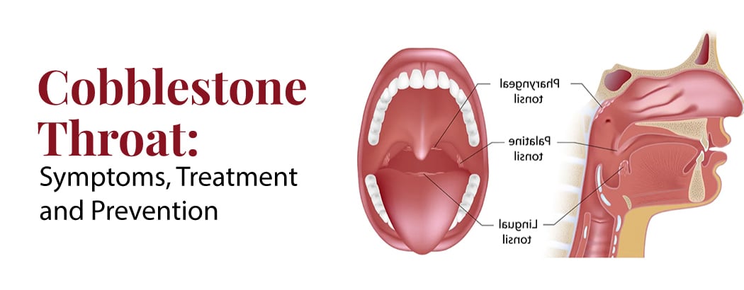 From Symptoms to Solutions: Exploring Cobblestone Throat Treatment and ... From Symptoms to Solutions: Exploring Cobblestone Throat Treatment and ...