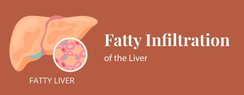 Fatty Infiltration of the Liver: Causes, Symptoms, and Prevention ...