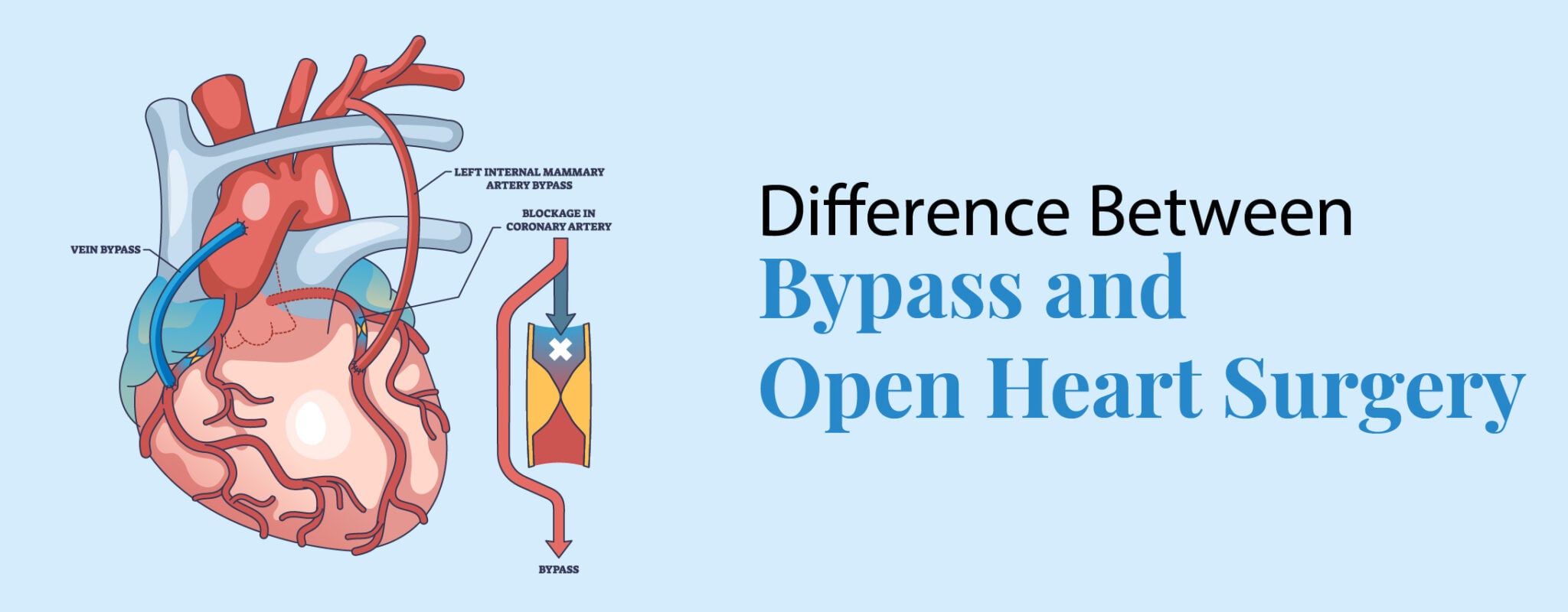 Difference Between Bypass and Open Heart Surgery