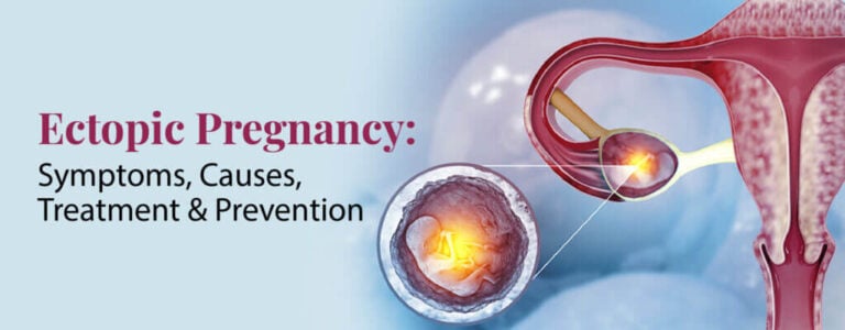 Ectopic Pregnancy: Types, Symptoms, Causes, & Treatment