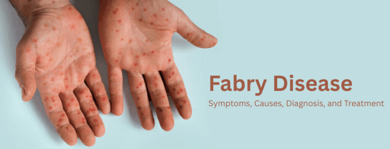 Fabry Disease: Symptoms, Causes, Diagnosis, and Treatment