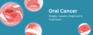 Oral Cancer: Stages, Causes, Diagnosis & Treatment
