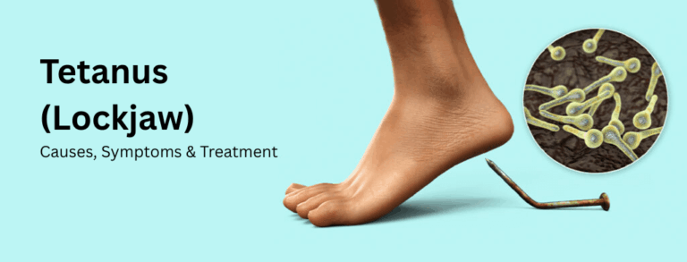 Tetanus (Lockjaw): Causes, Symptoms & Treatment