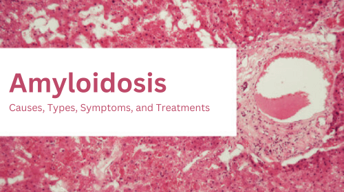 Amyloidosis: Causes, Types, Symptoms, and Treatments