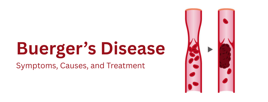 Buerger’s Disease: Symptoms, Causes, and Treatment