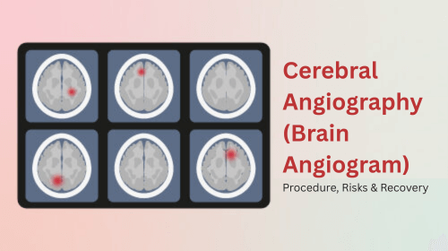 Cerebral Angiography (Brain Angiogram): Procedure, Risks & Recovery