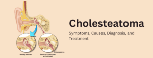 Cholesteatoma: Symptoms, Causes, Diagnosis, and Treatment