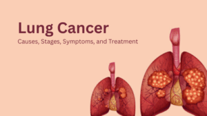 Lung Cancer: Causes, Stages, Symptoms, and Treatment