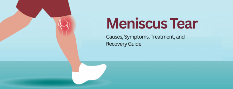 Meniscus Tear: Causes, Symptoms, Treatment, and Recovery Guide