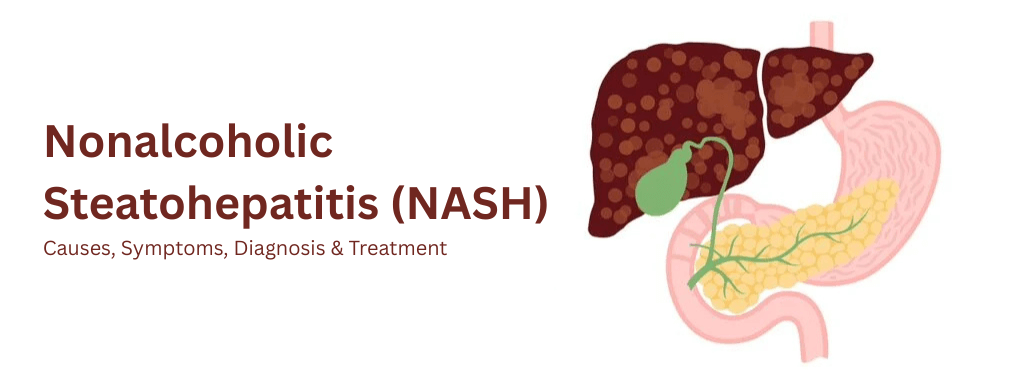 Nonalcoholic Steatohepatitis (NASH): Causes, Symptoms, Diagnosis ...