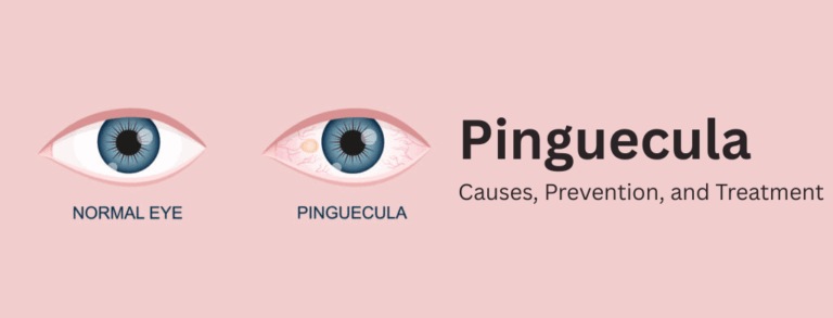 Pinguecula: Causes, Symptoms, Prevention, and Treatment
