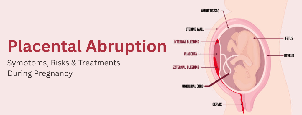 Placental Abruption: Symptoms, Risks & Treatments During Pregnancy