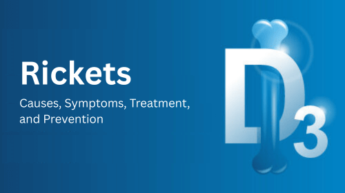 Rickets: Causes, Symptoms, Treatment, and Prevention