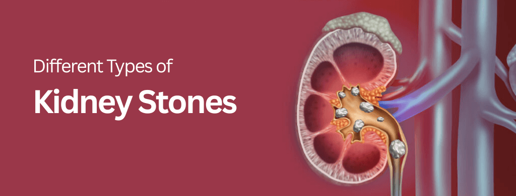 Different Types of Kidney Stones Explained