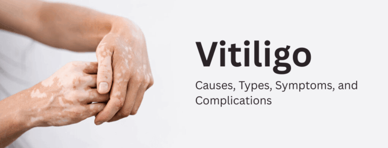 Vitiligo: Causes, Types, Symptoms, and Treatment