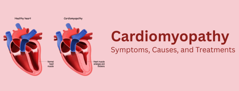 Cardiomyopathy: Symptoms, Causes, and Treatments