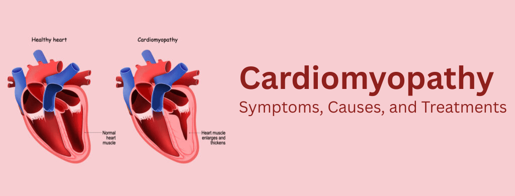 Cardiomyopathy: Symptoms, Causes, and Treatments