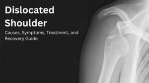 Dislocated Shoulder: Causes, Symptoms, Treatment, and Recovery Guide