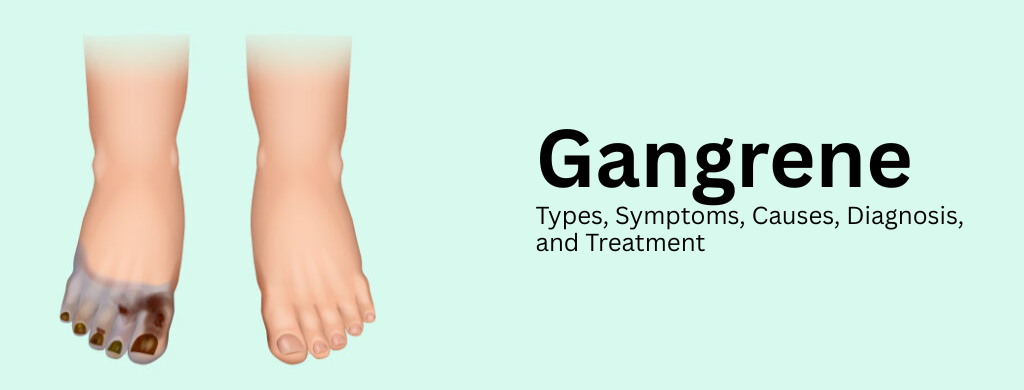 Gangrene: Types, Symptoms, Causes, Diagnosis, and Treatment