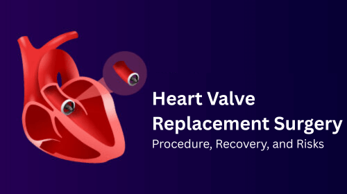 Heart Valve Replacement Surgery: Procedure, Recovery, and Risks