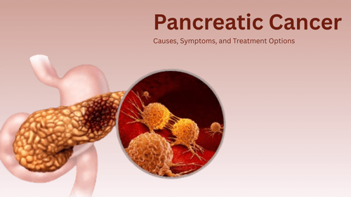 Pancreatic Cancer: Causes, Symptoms, and Treatment Options
