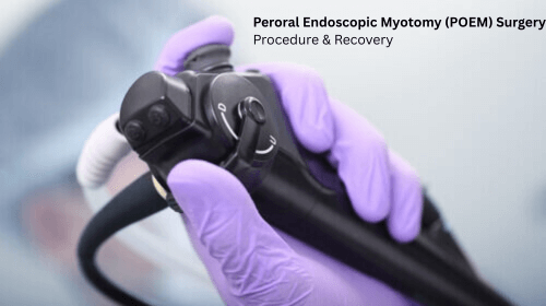 Peroral Endoscopic Myotomy (POEM) Surgery - Procedure & Recovery