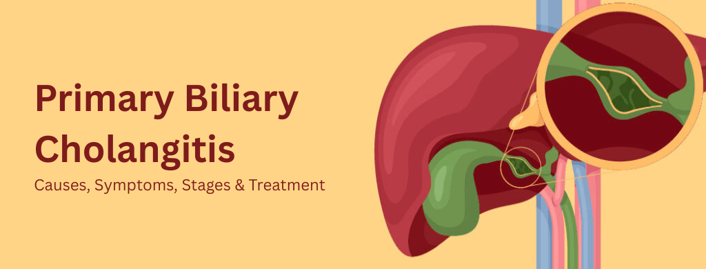 Primary Biliary Cholangitis (PBC): Causes, Symptoms, Stages & Treatment