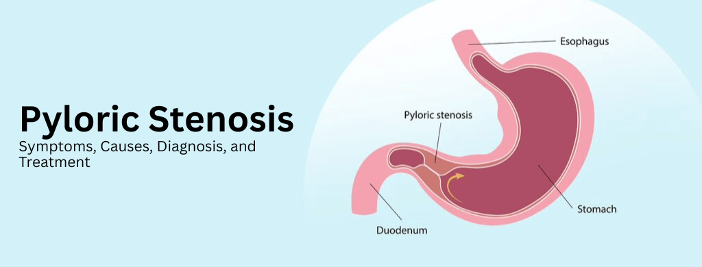 Pyloric Stenosis: Symptoms, Causes, Diagnosis, and Treatment