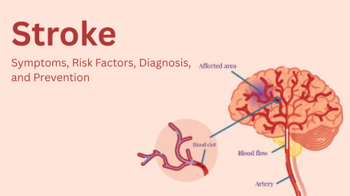 Stroke: Symptoms, Risk Factors, Diagnosis, and Prevention