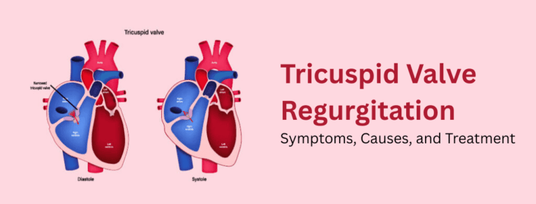 Tricuspid Valve Regurgitation: Symptoms, Causes, and Treatment
