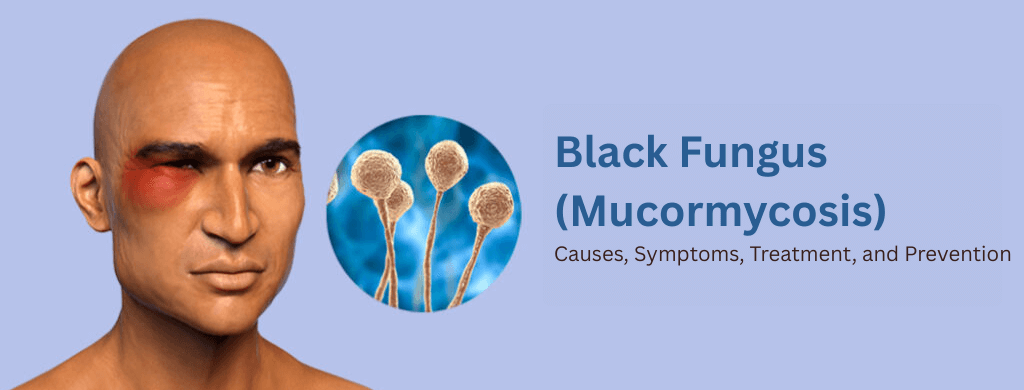 Black Fungus (Mucormycosis): Causes, Symptoms, Treatment, and Prevention