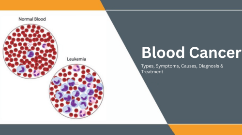 Blood Cancer: Types, Symptoms, Causes, Diagnosis & Treatment