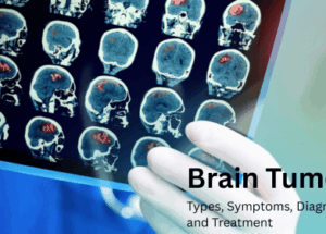 Brain Tumors: Types, Symptoms, Diagnosis, and Treatment