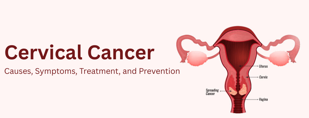 Cervical Cancer: Causes, Symptoms, Treatment, and Prevention