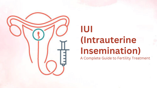 IUI (Intrauterine Insemination): A Complete Guide to Fertility Treatment