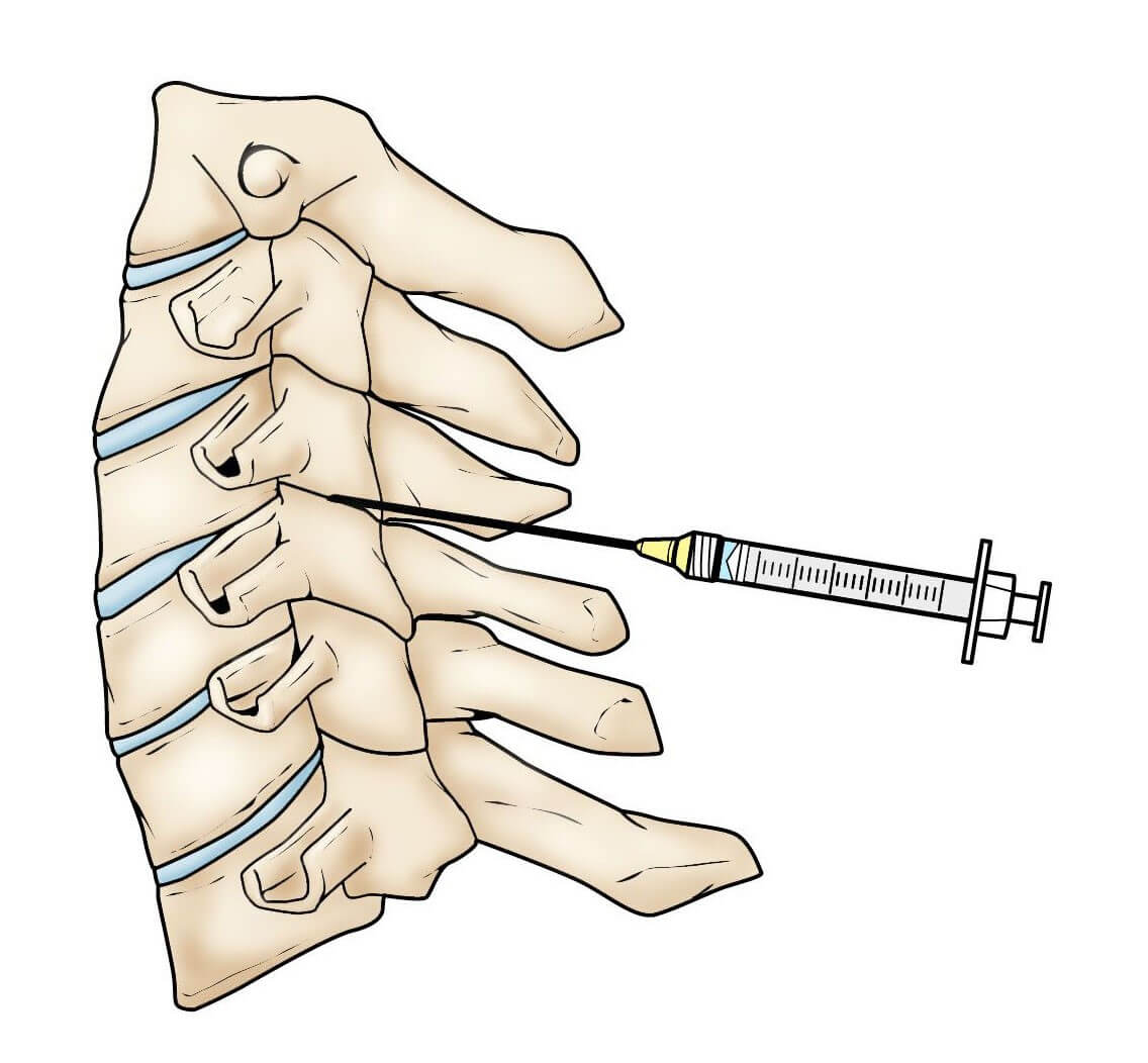 Spinal Injections: Types, Procedure, Benefits, and Risks