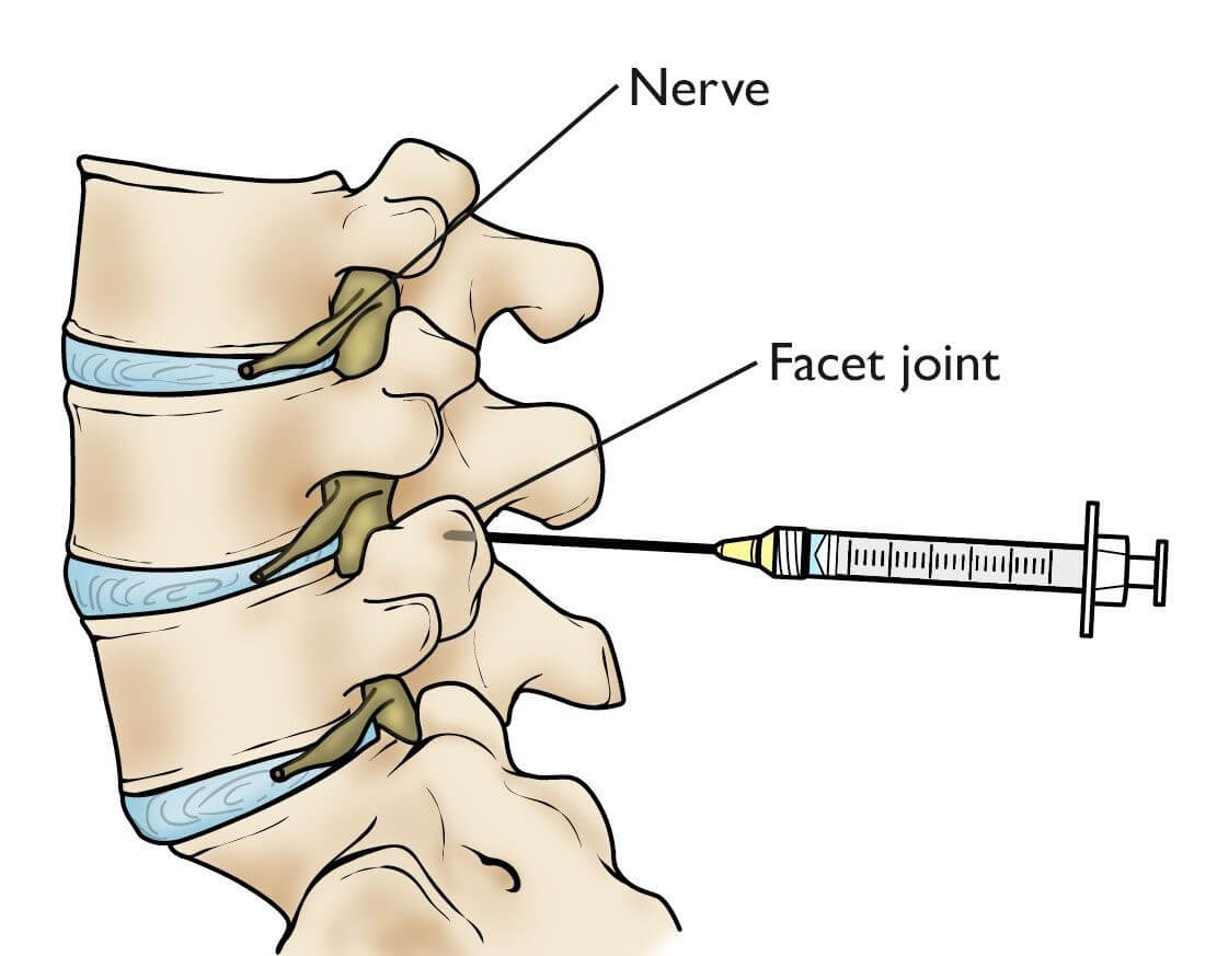 Spinal Injections: Types, Procedure, Benefits, and Risks